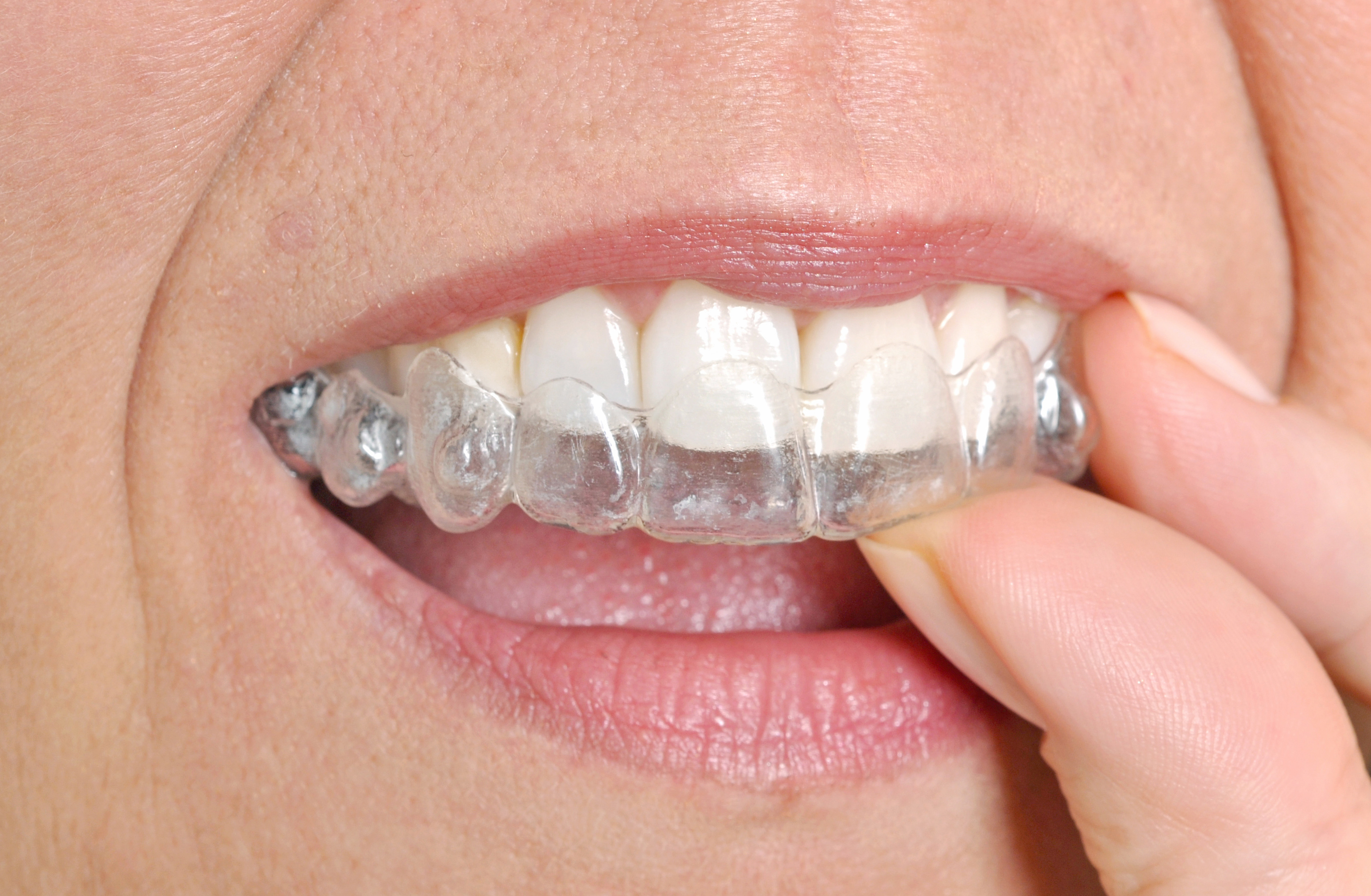 Invisalign - Weymouth, MA - Comfort Dental